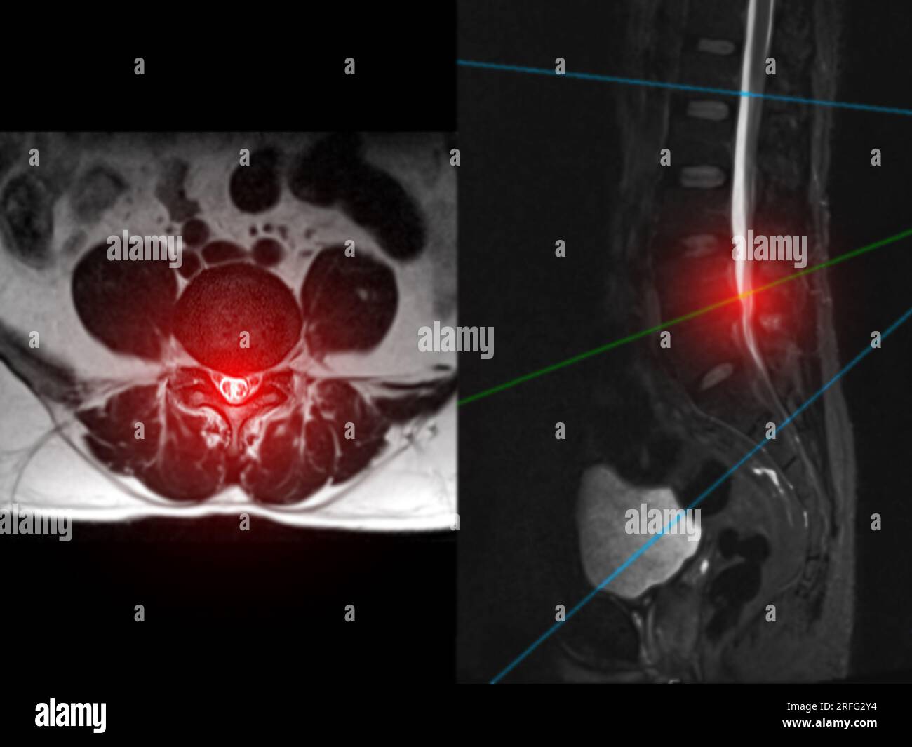 MRI L-S spine or lumbar spine Axial T2W view with sagittal plane for ...