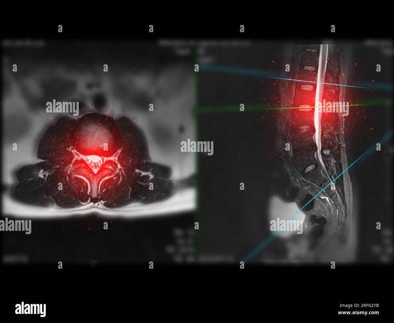 Mri L S Spine Or Lumbar Spine Axial T2w View With Sagittal Plane For
