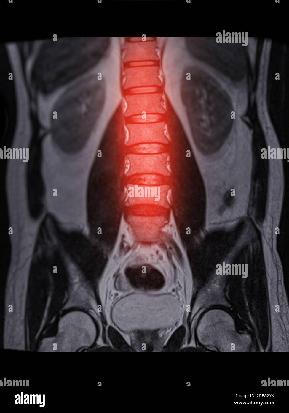 MRI L-S spine or lumbar spine Coronal T2 FS plane for diagnosis spinal ...