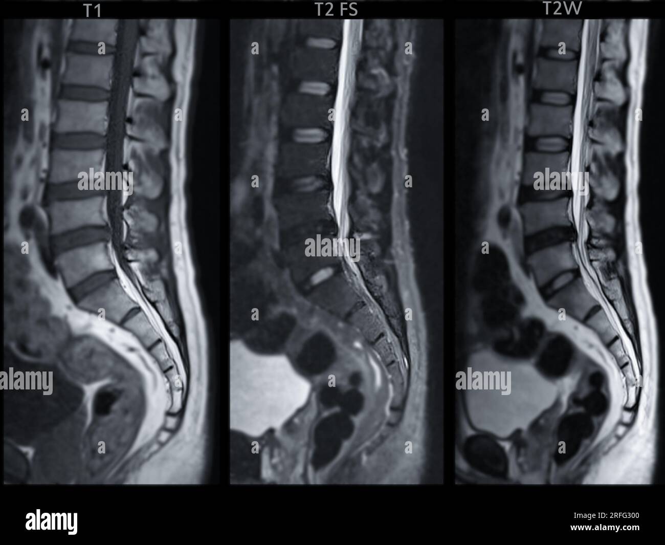 MRI L-S spine or lumbar spine Sagittall T1W ,T2 FS and T2W view for diagnosis spinal cord ...
