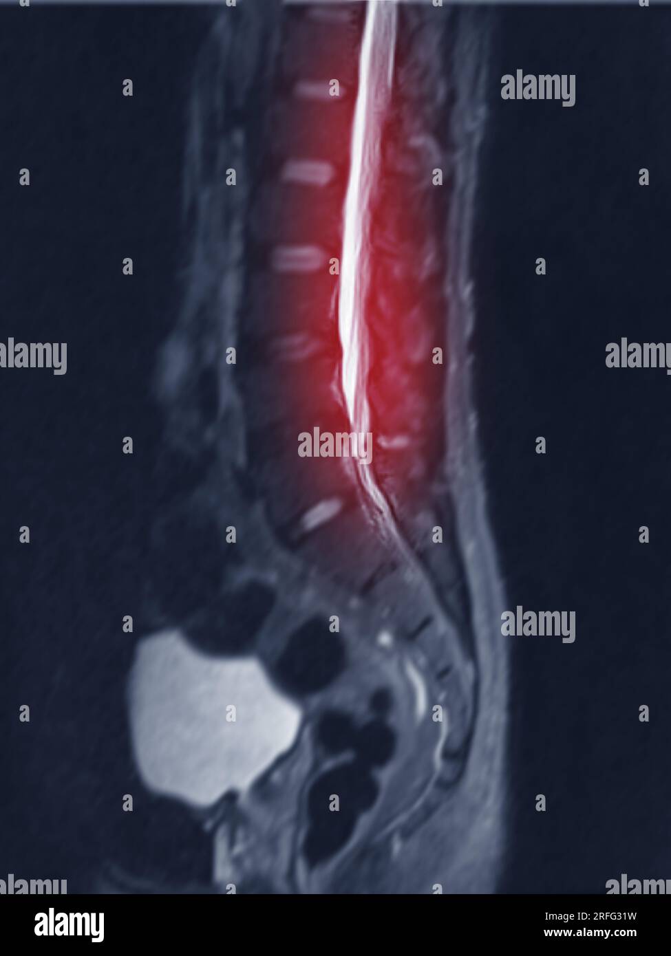 MRI L-S spine or lumbar spine Sagittall T2 FS view for diagnosis spinal ...