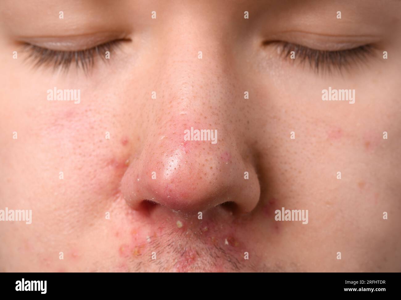 Acne problem hi-res stock photography and images - Alamy