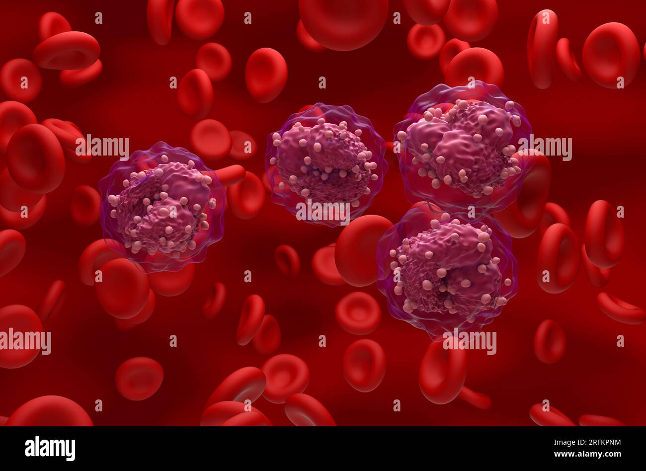 Acute lymphoblastic leukemia (ALL) cancer cells in the blood flow ...
