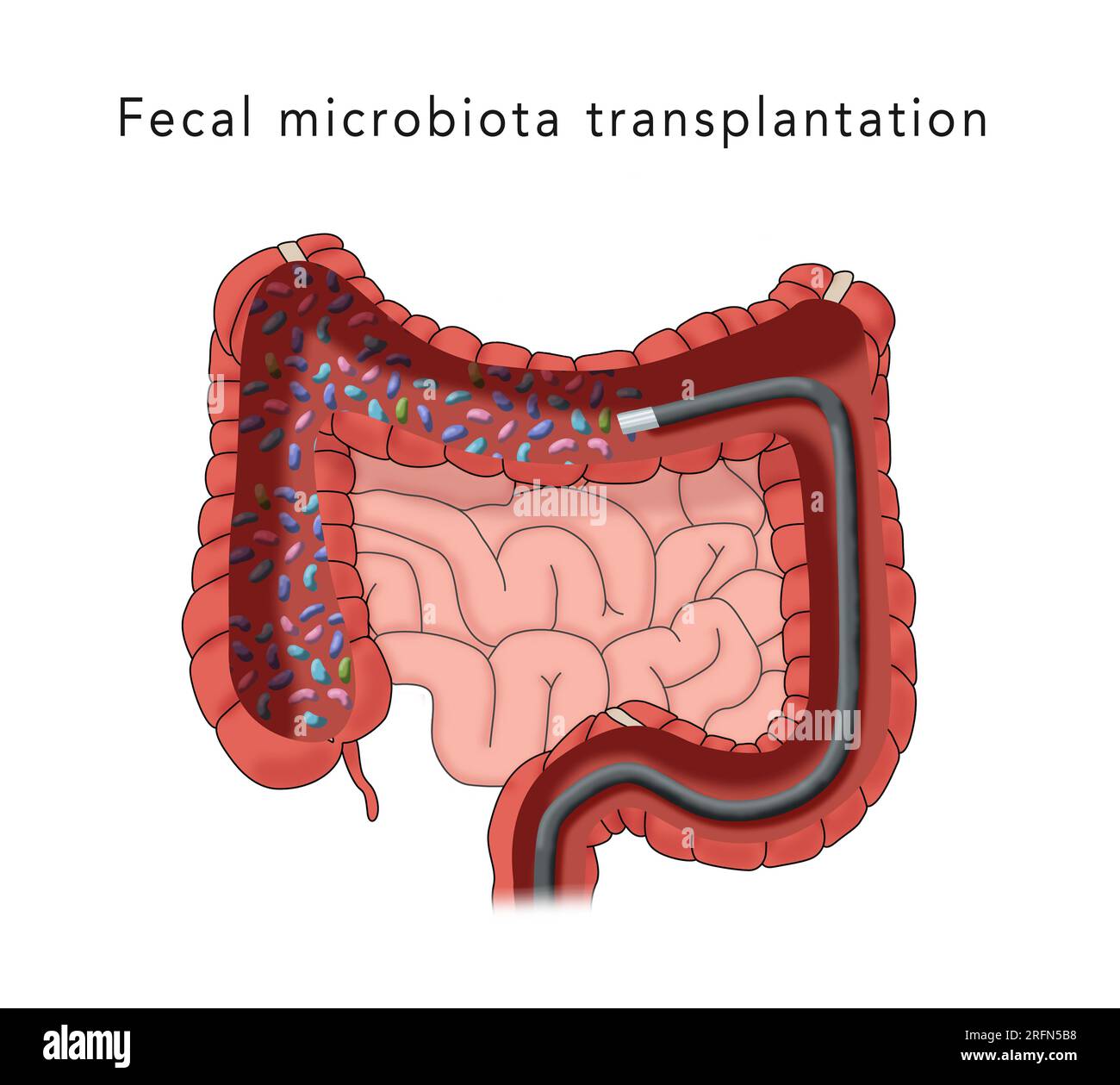 Colonoscopy hi-res stock photography and images - Alamy