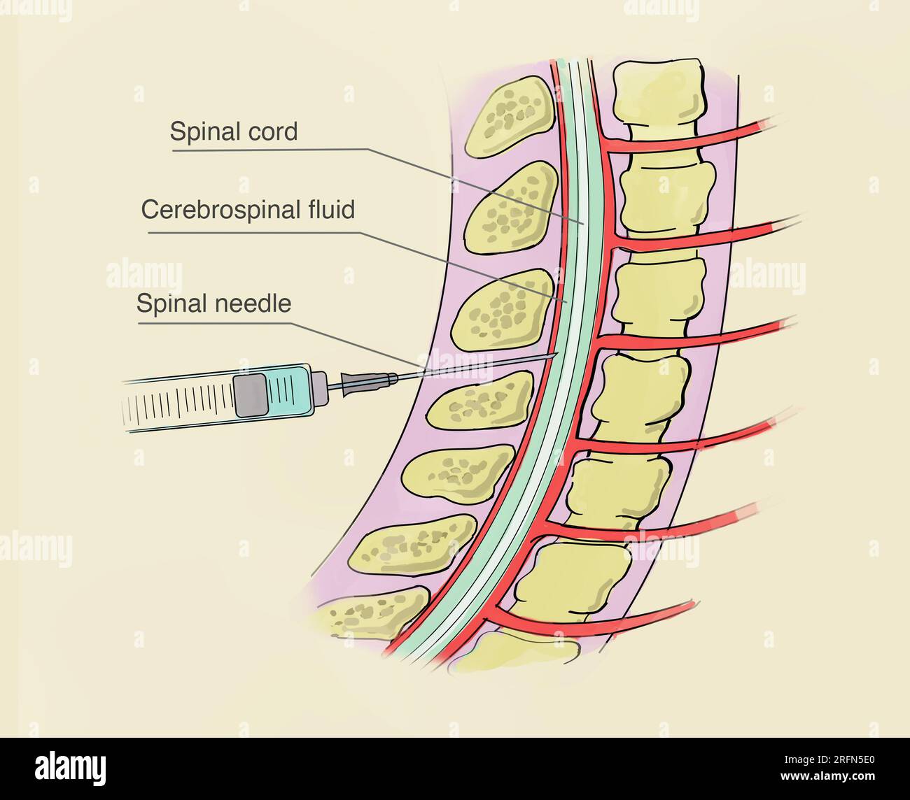 What Is Lumbar Puncture Lp At Helen Fisk Blog What Is Lumbar Puncture Lp At Helen Fisk Blog