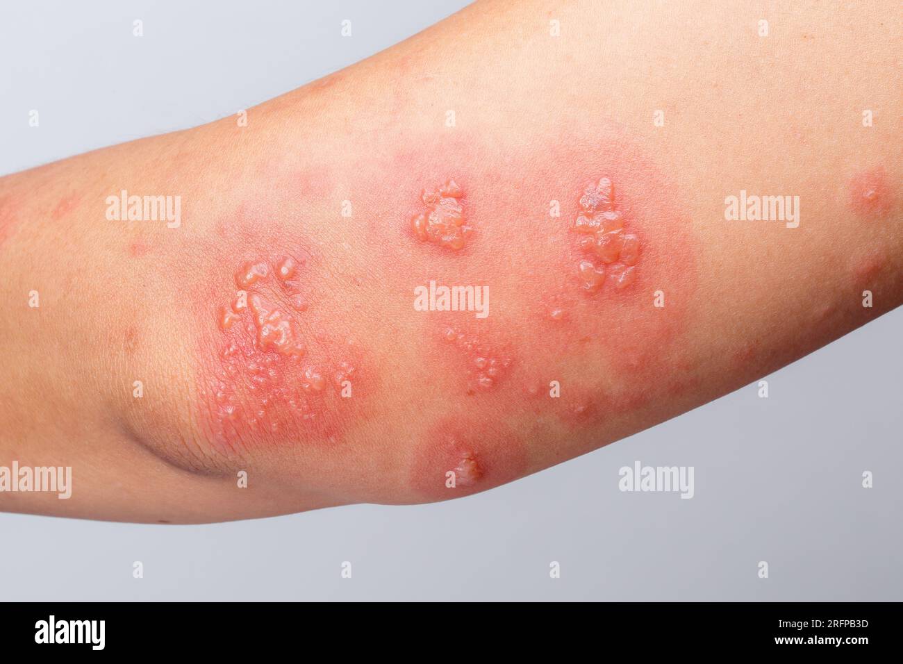 Shingles, Zoster or Herpes Zoster symptoms on arm Stock Photo - Alamy