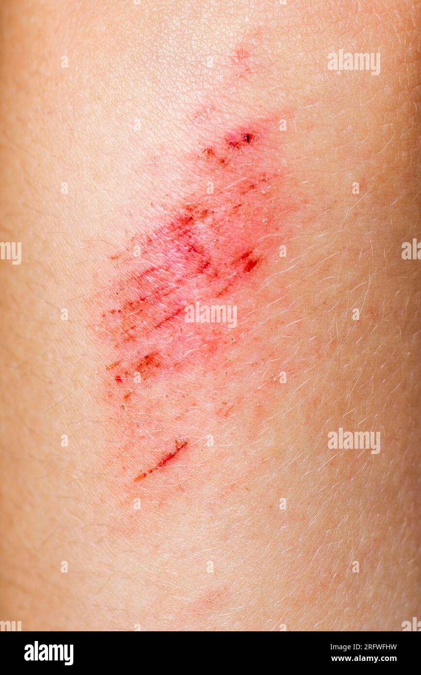 Wounds on the skin. Deep scratches on the skin Stock Photo - Alamy