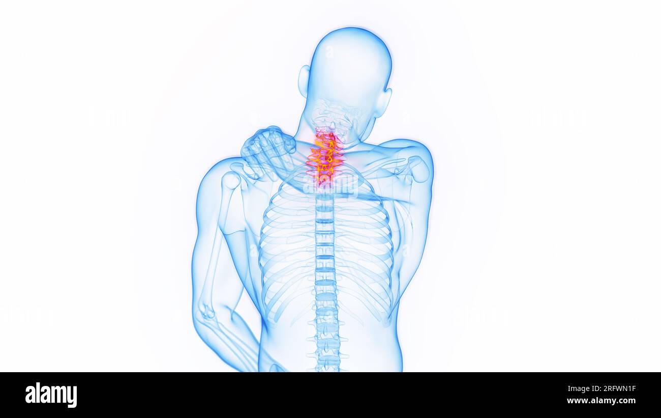 Neck pain, illustration Stock Photo - Alamy
