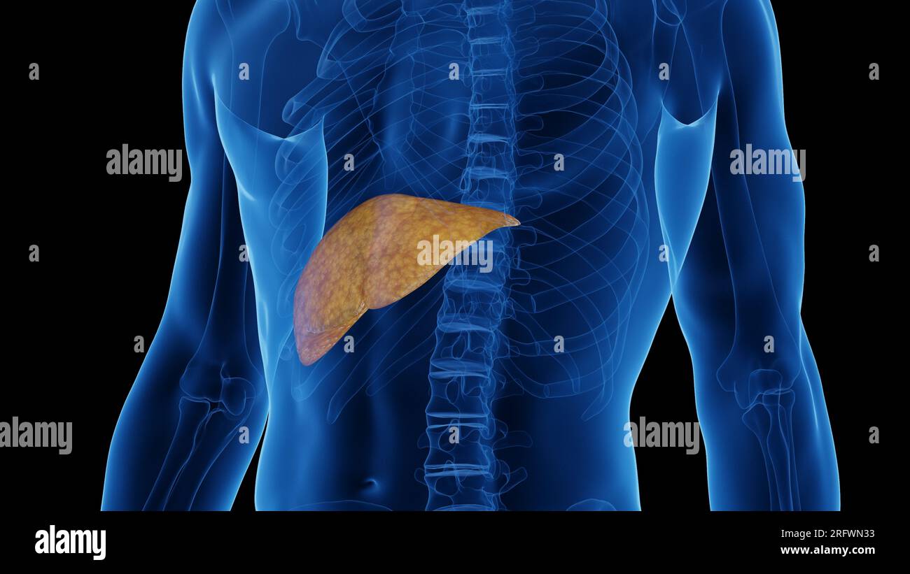 Fatty liver, illustration Stock Photo - Alamy