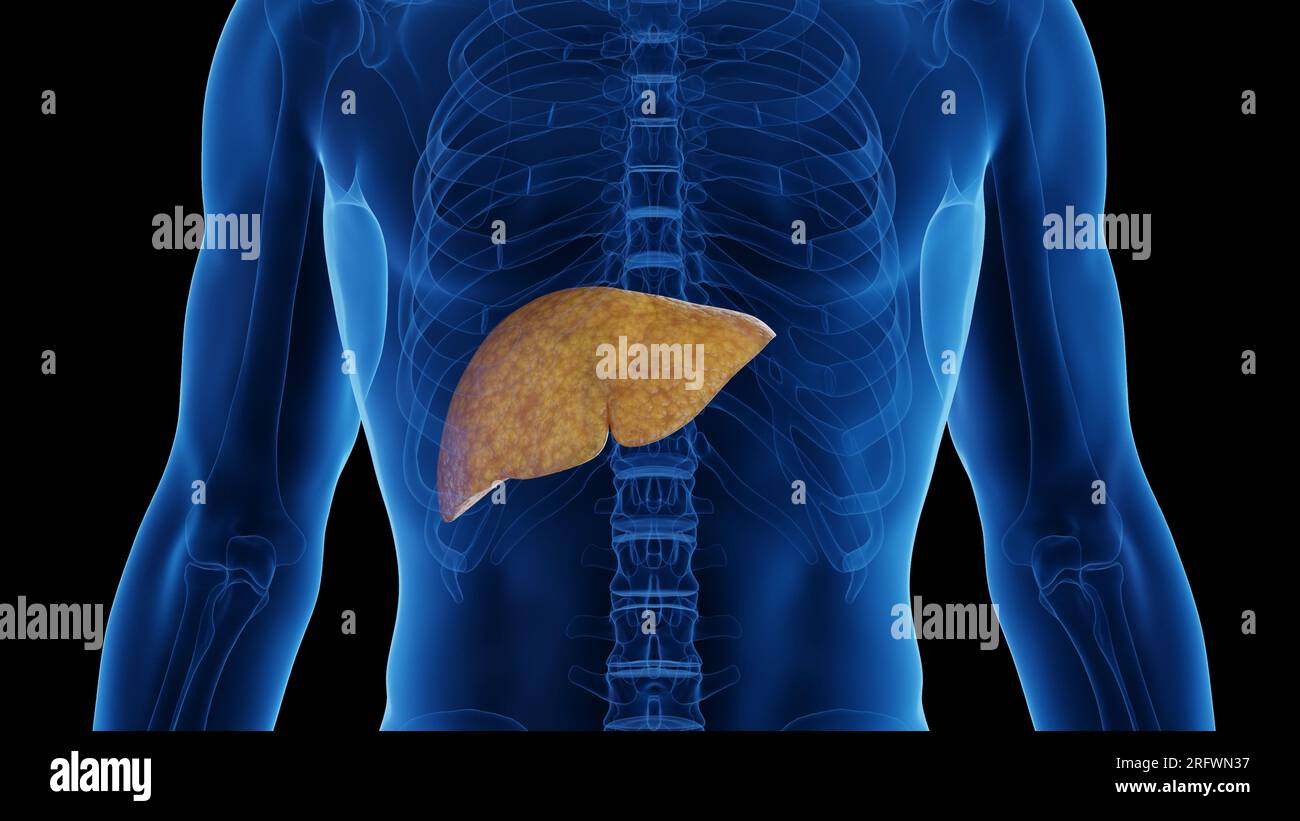 Fatty liver, illustration Stock Photo - Alamy
