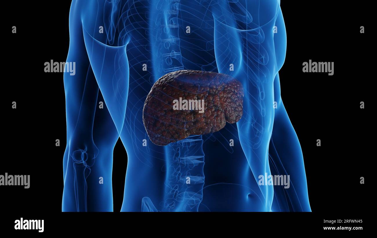 Cirrhotic liver hi-res stock photography and images - Alamy