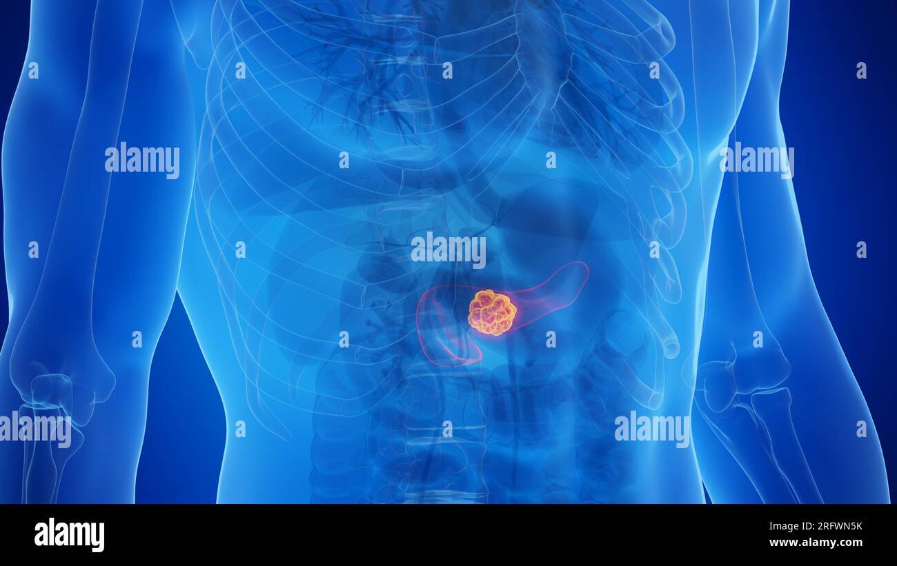 Pancreatic cancer, illustration Stock Photo - Alamy