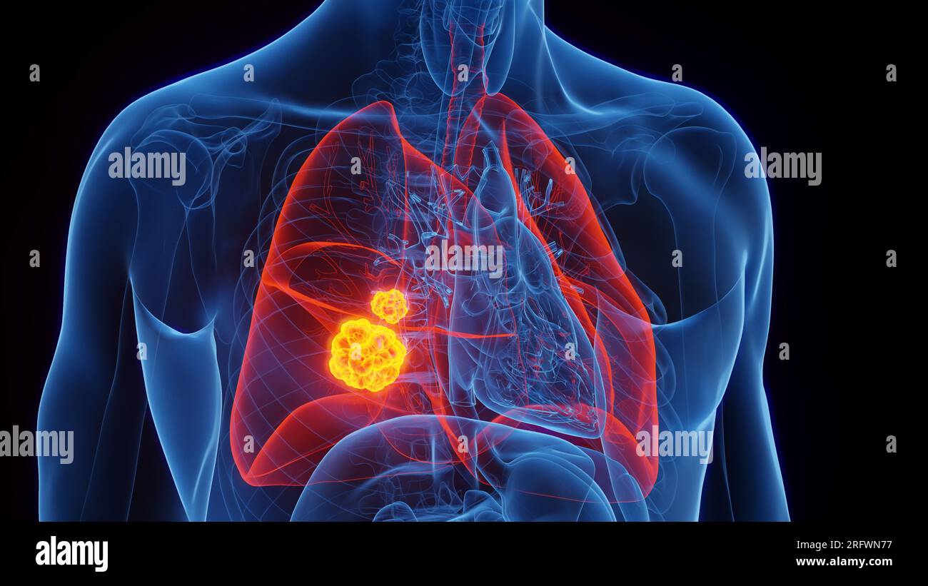 Lung cancer, illustration Stock Photo - Alamy