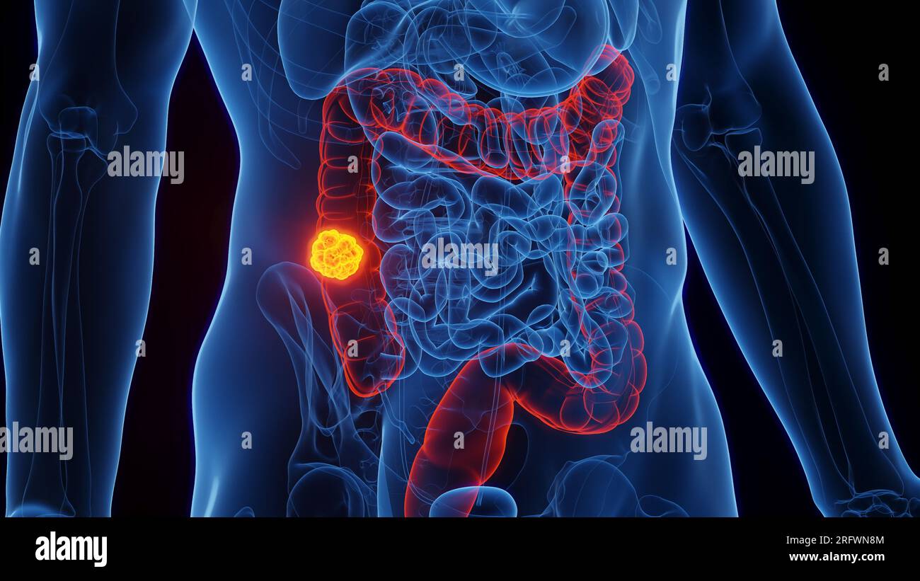 Colon cancer, illustration Stock Photo - Alamy