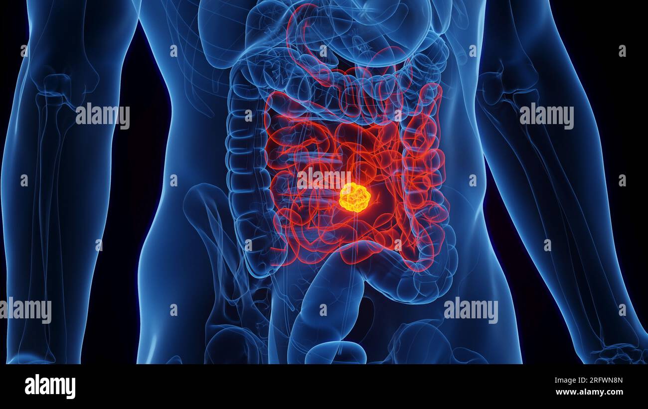 Small bowel tumor hi-res stock photography and images - Alamy