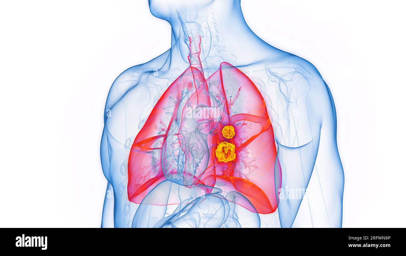 Lung cancer, illustration Stock Photo - Alamy