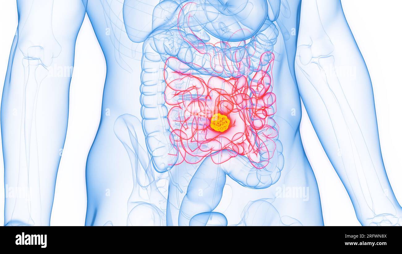 Cancer of the small intestine, illustration Stock Photo - Alamy