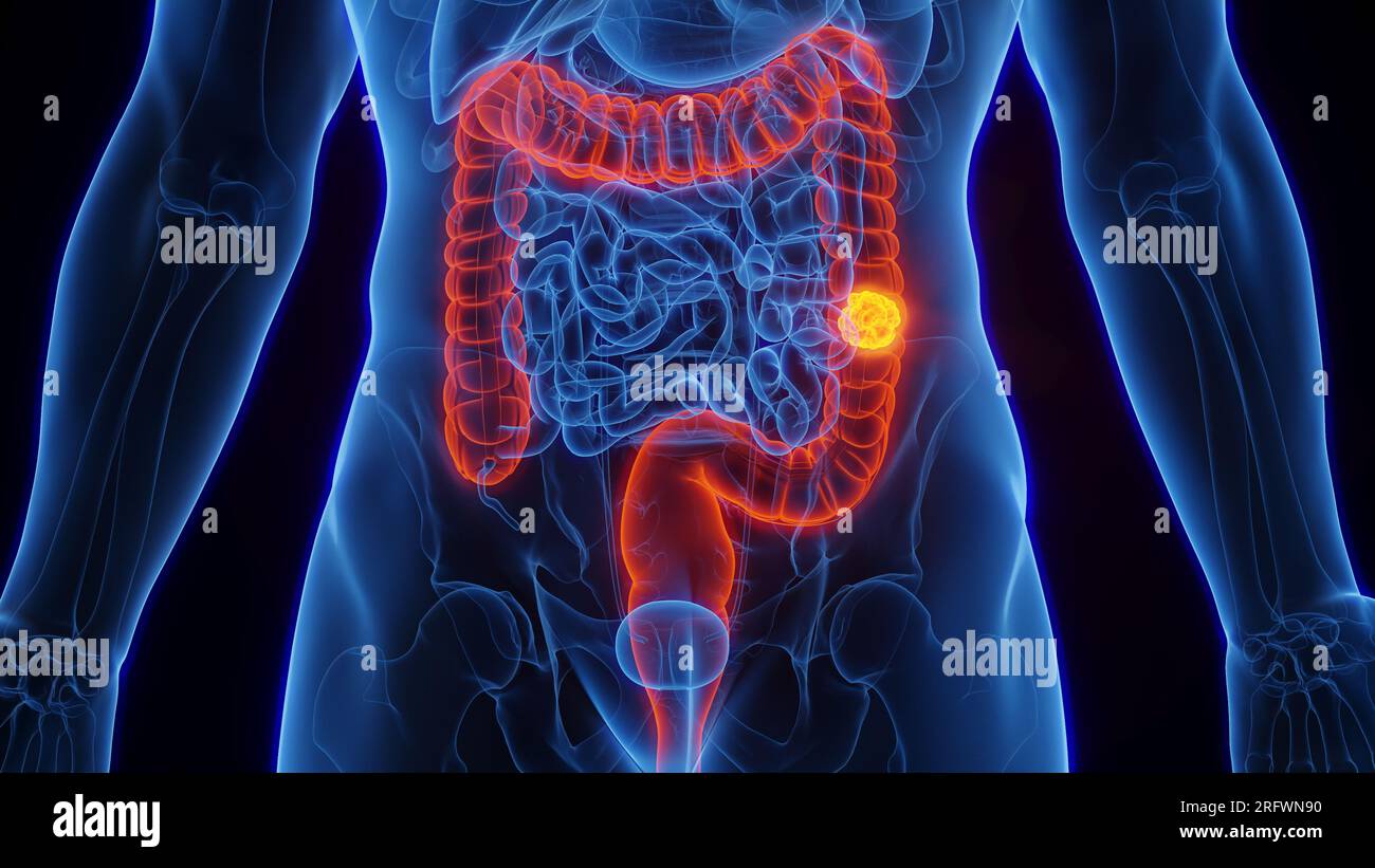 Colon cancer, illustration Stock Photo - Alamy