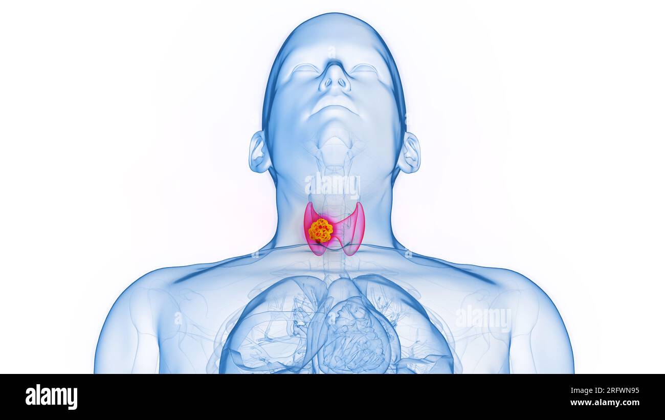 Thyroid cancer, illustration Stock Photo - Alamy