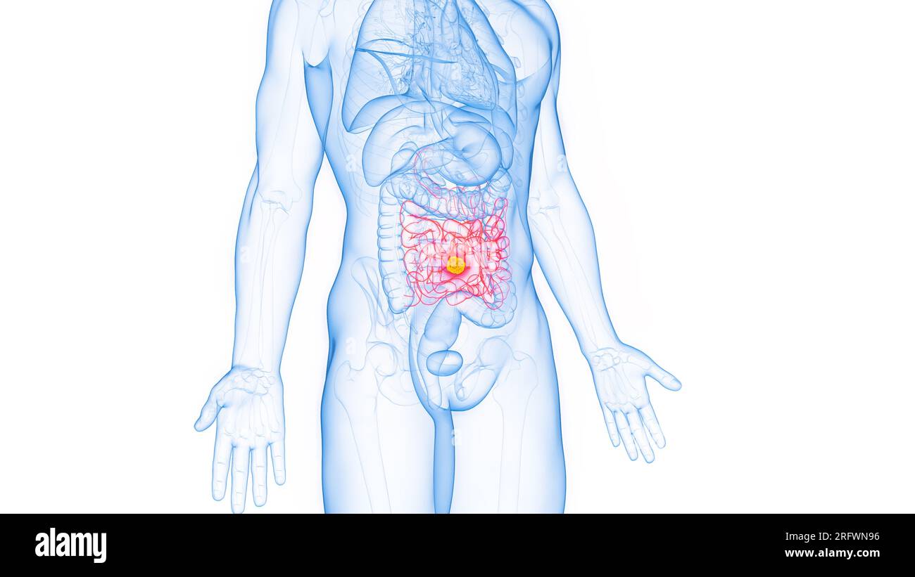 Cancer of the small intestine, illustration Stock Photo - Alamy