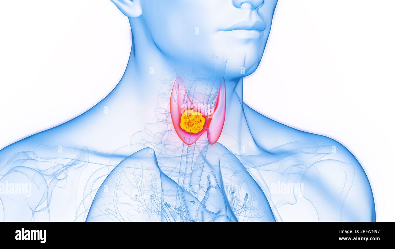Thyroid cancer, illustration Stock Photo - Alamy