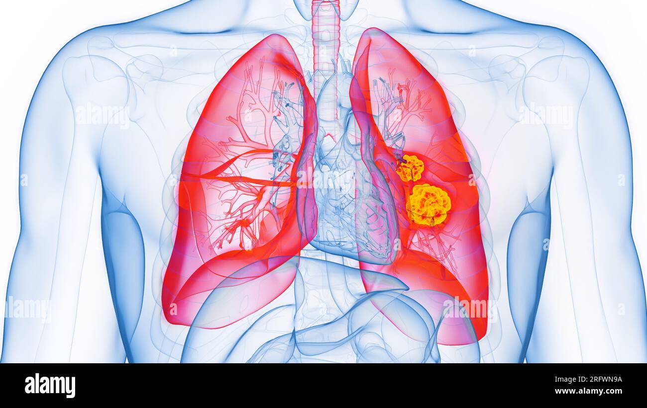 Lung cancer, illustration Stock Photo - Alamy