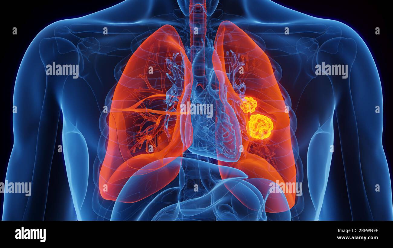 Lung cancer, illustration Stock Photo - Alamy