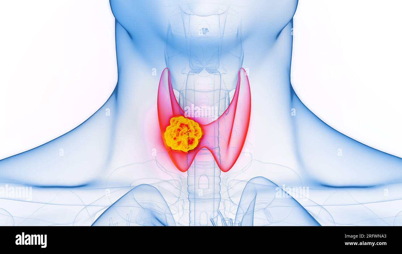 Thyroid cancer, illustration Stock Photo - Alamy