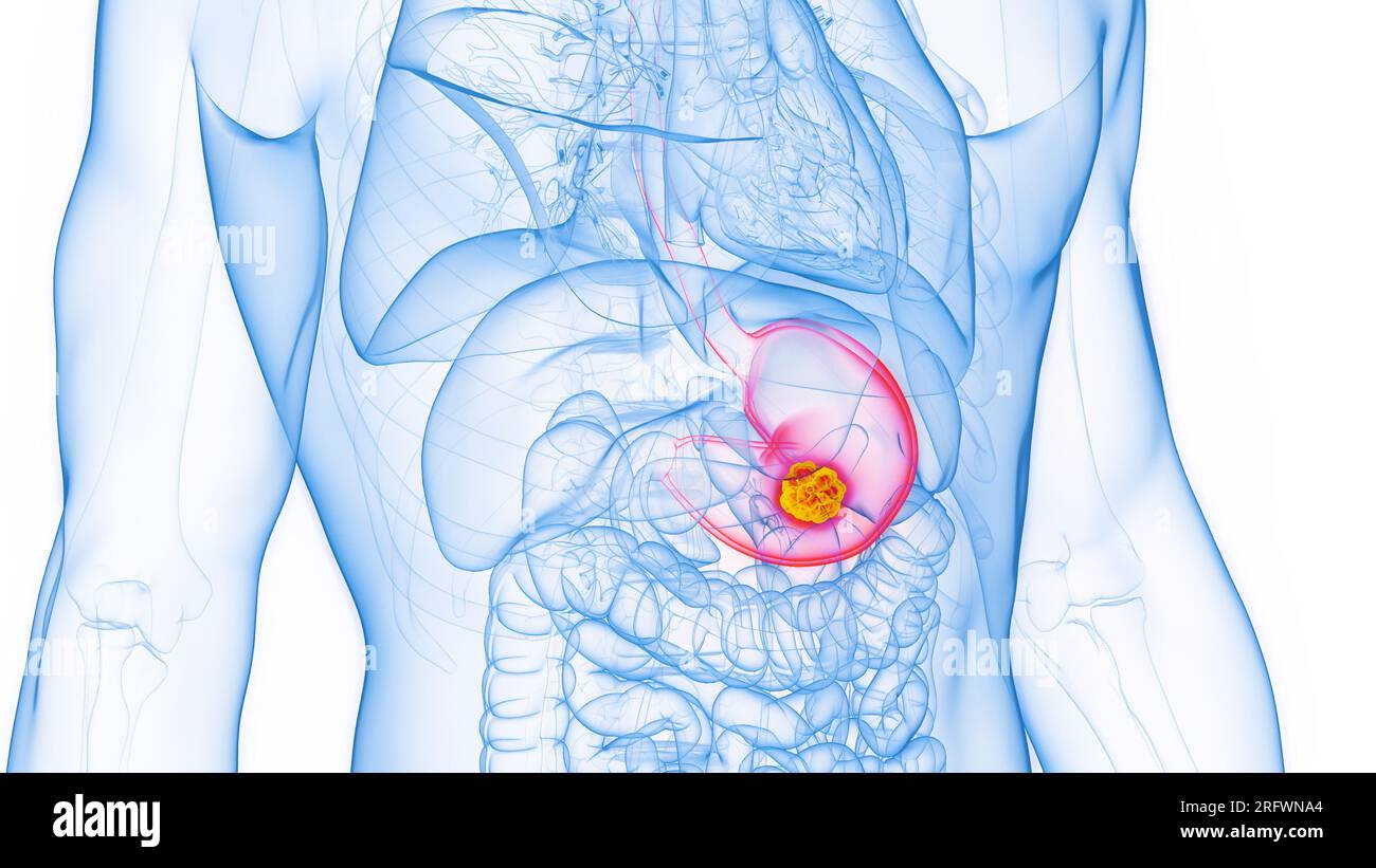 Stomach cancer, illustration Stock Photo - Alamy