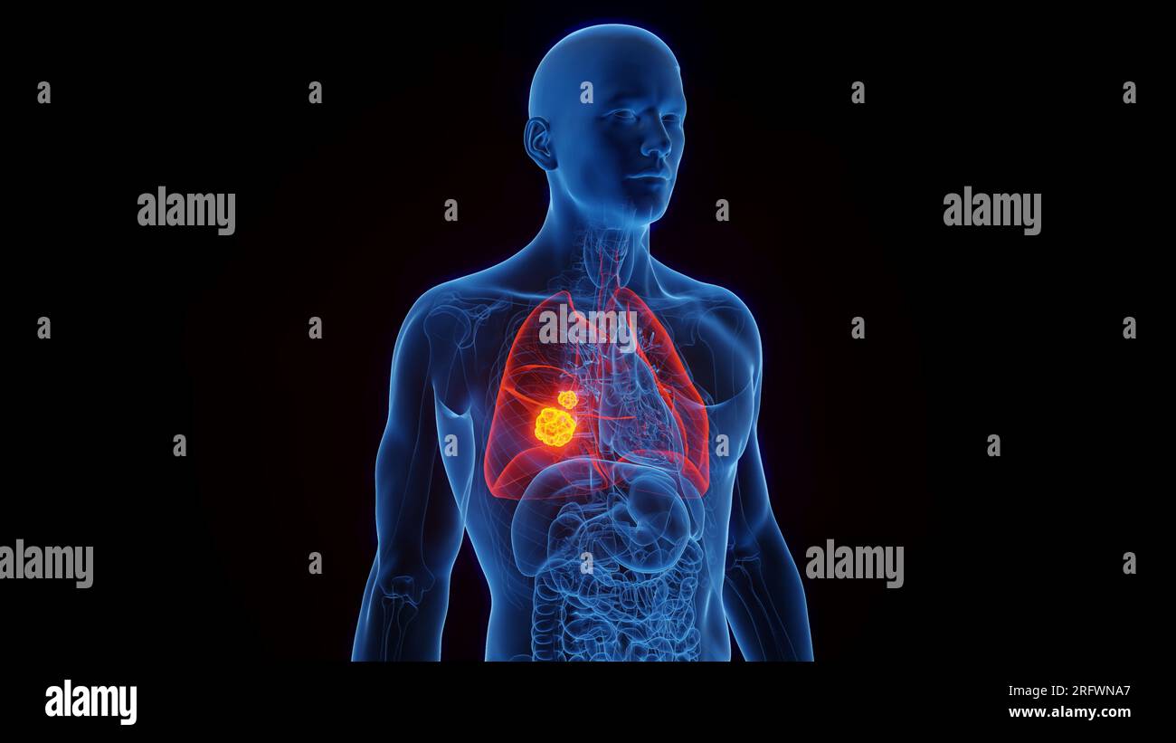 Lung cancer, illustration Stock Photo - Alamy