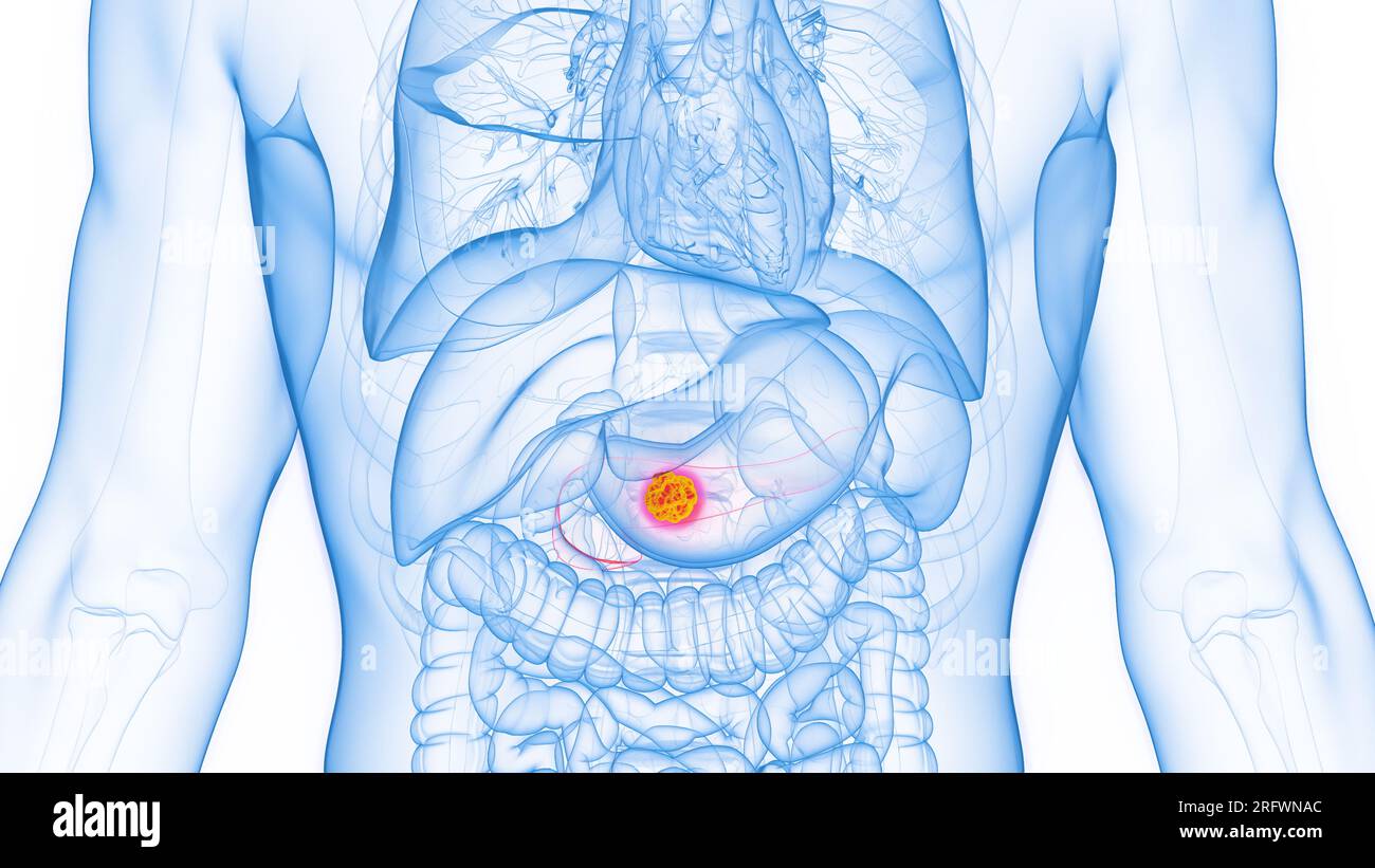 Pancreatic mass hi-res stock photography and images - Alamy