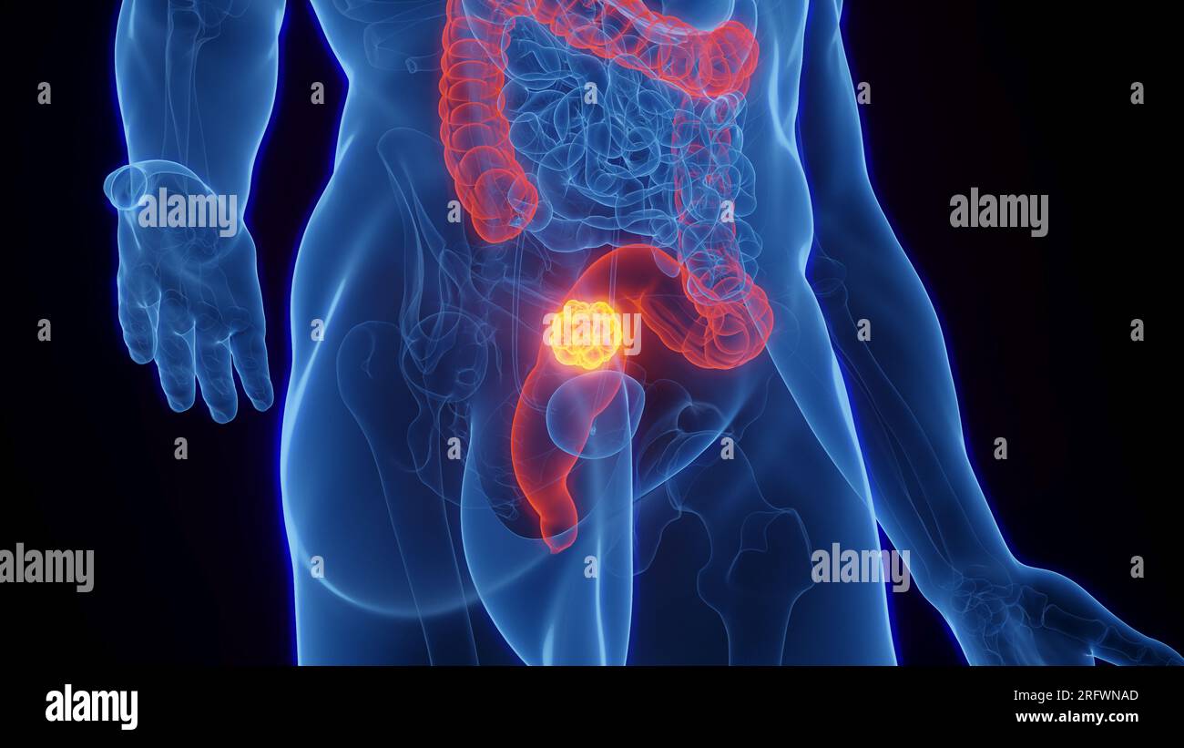 Rectal cancer, illustration Stock Photo - Alamy