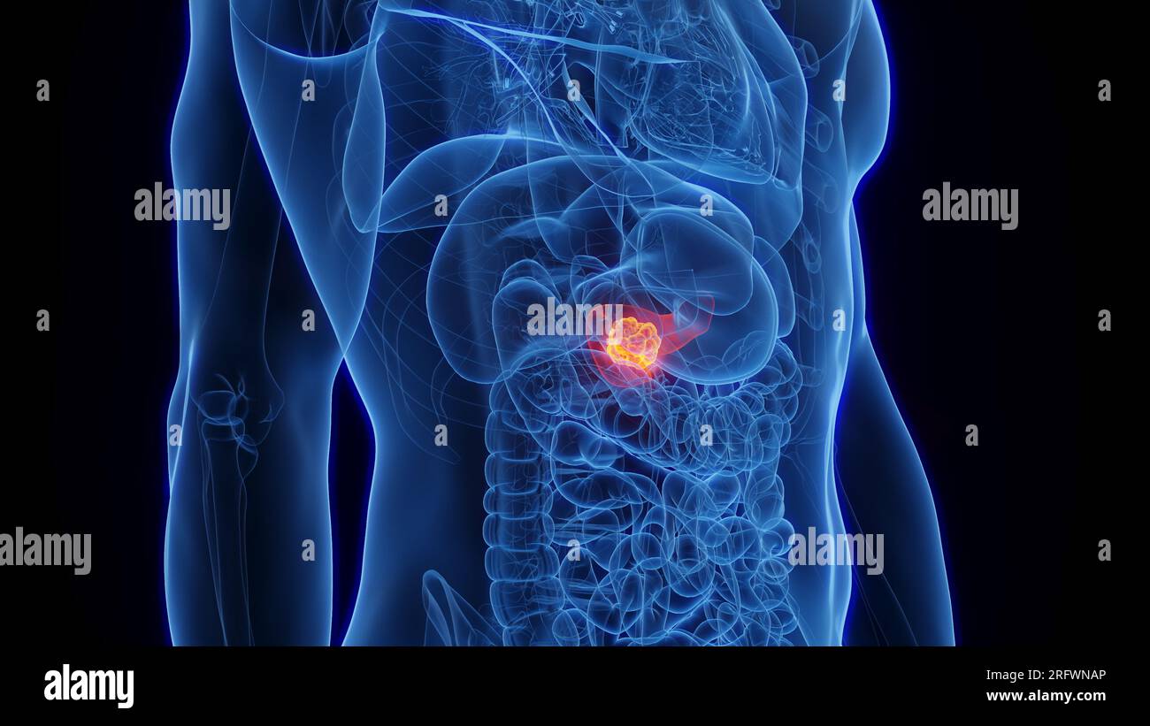 Pancreatic cancer, illustration Stock Photo - Alamy