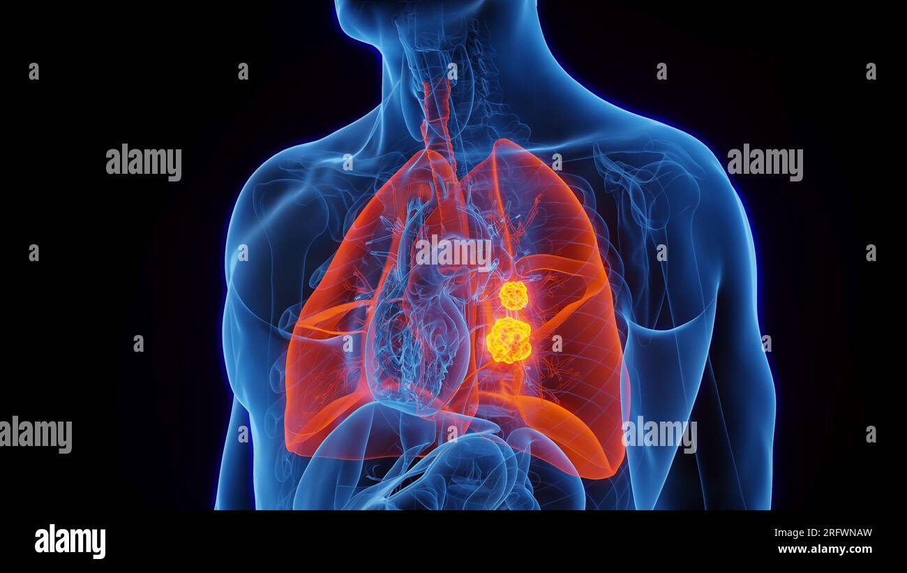 Lung cancer, illustration Stock Photo - Alamy