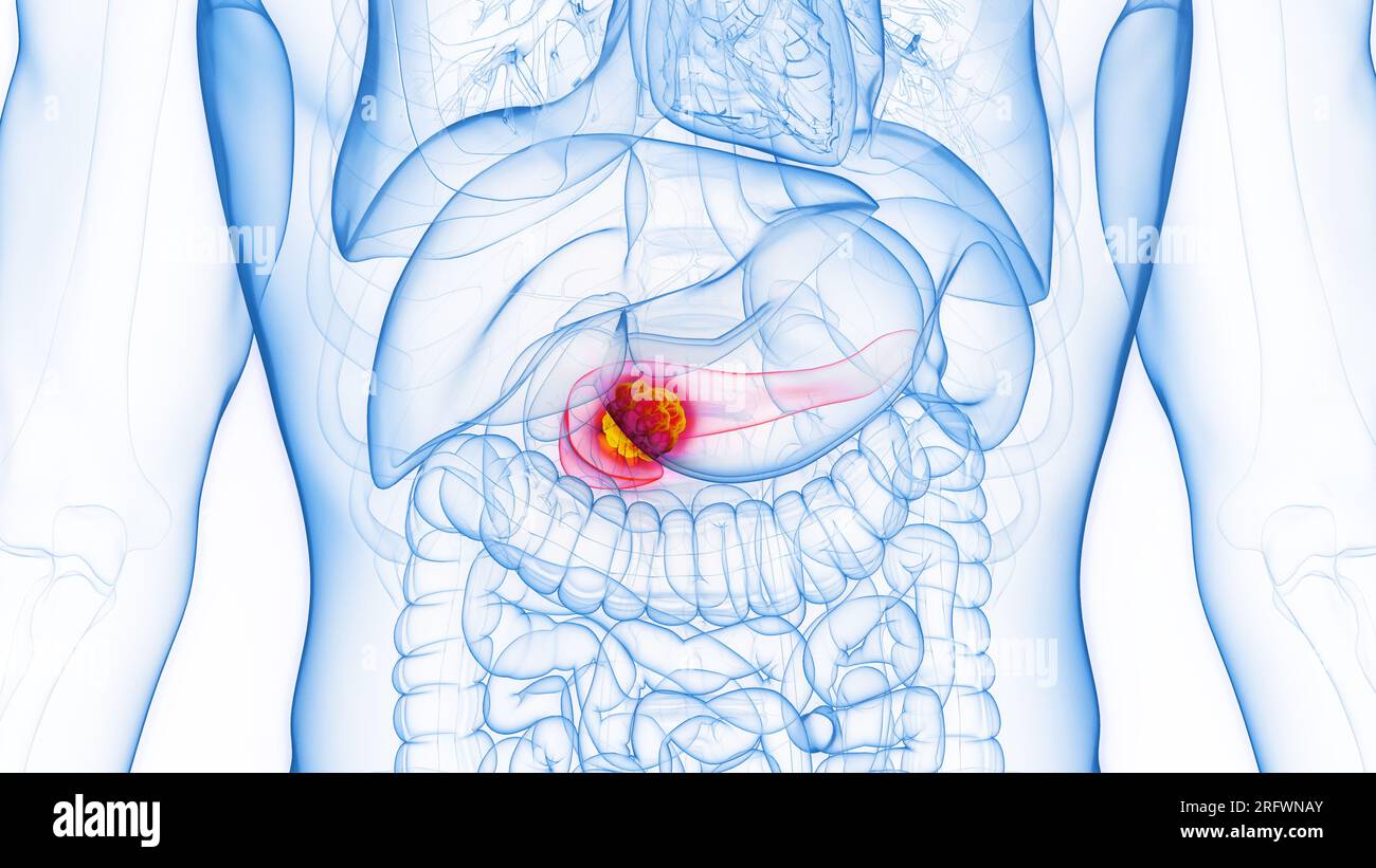 Pancreatic cancer, illustration Stock Photo - Alamy