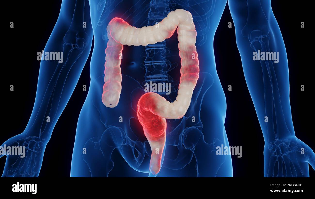 Inflamed colon, illustration Stock Photo - Alamy