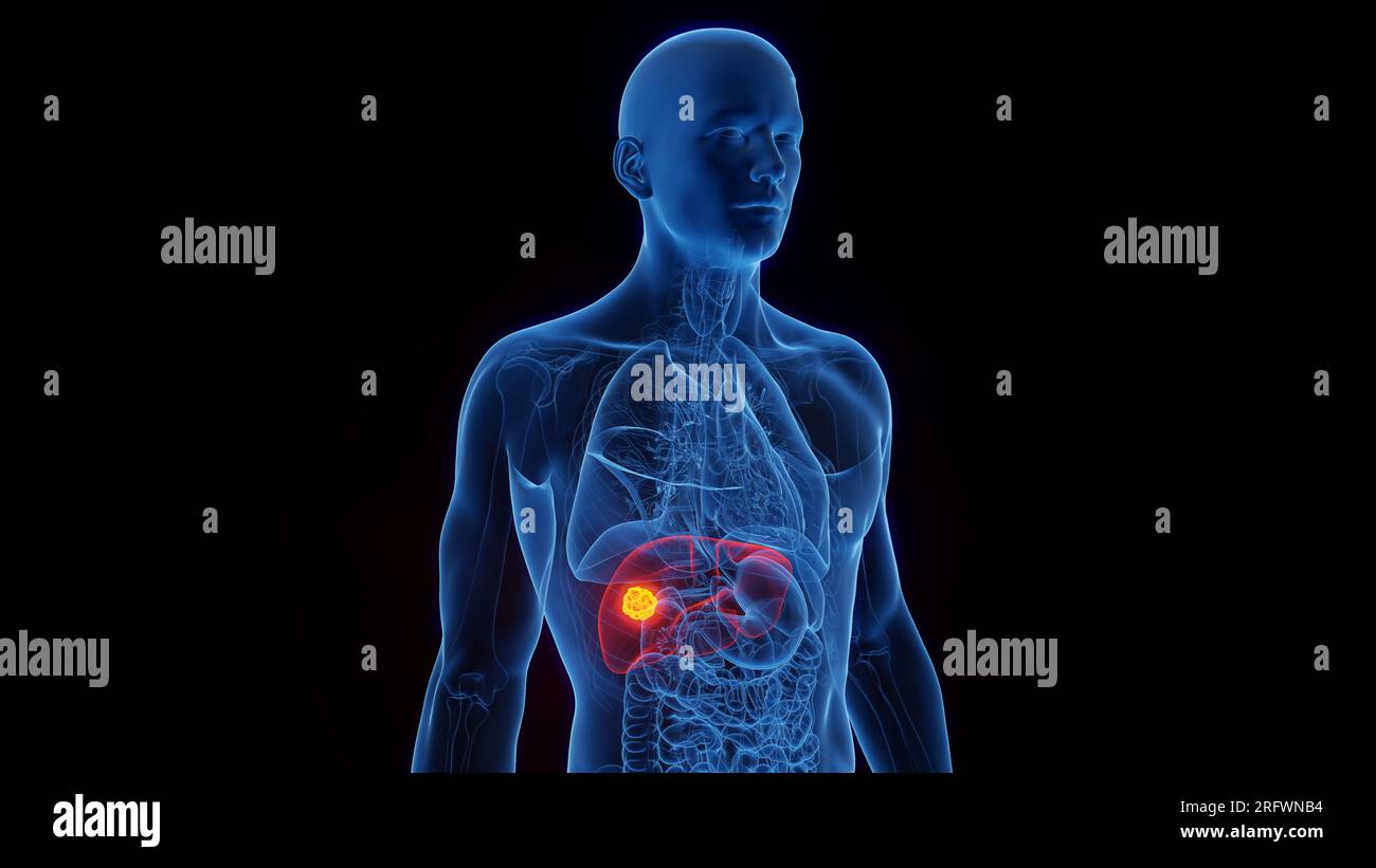 Liver cancer, illustration Stock Photo - Alamy