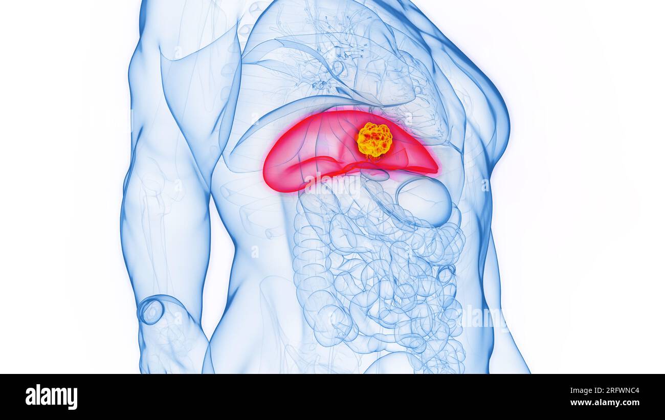 Liver cancer, illustration Stock Photo - Alamy