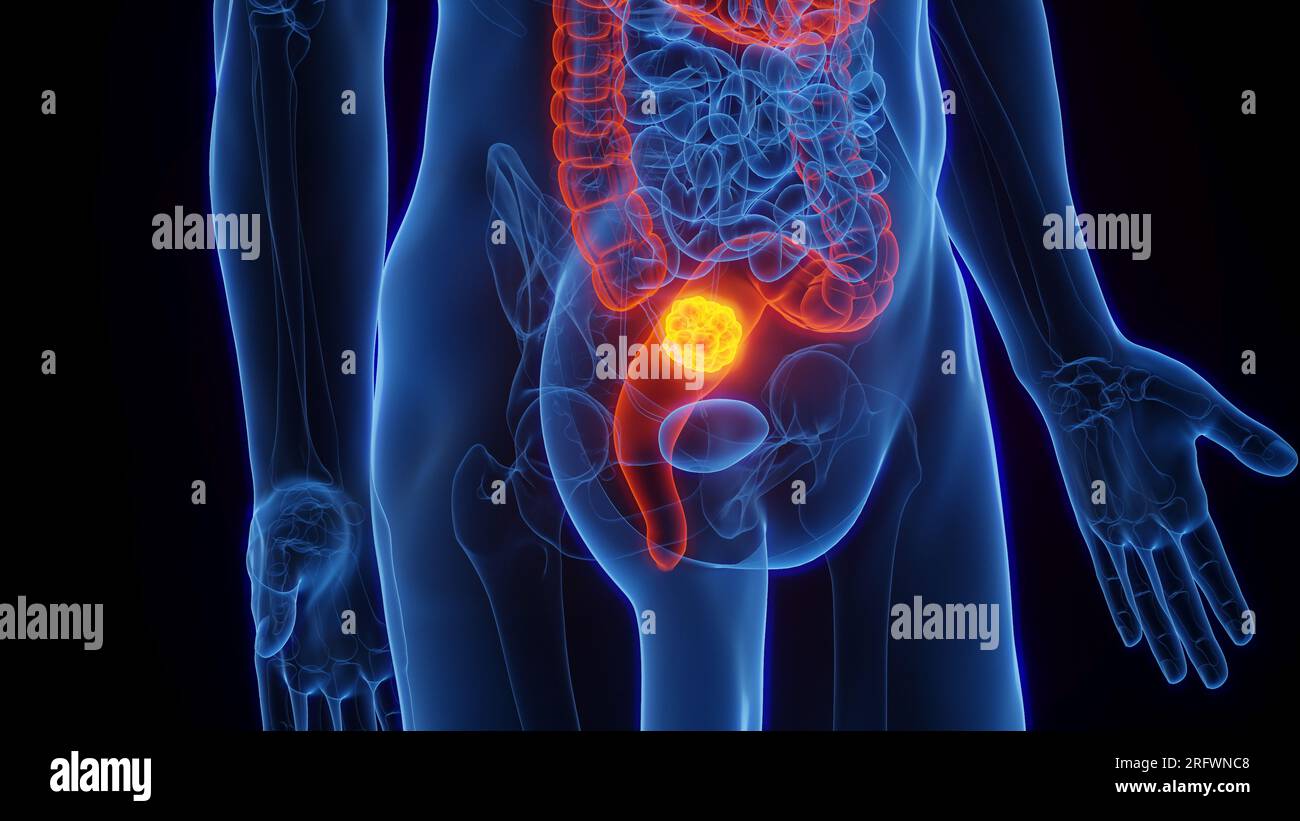Rectal cancer, illustration Stock Photo - Alamy