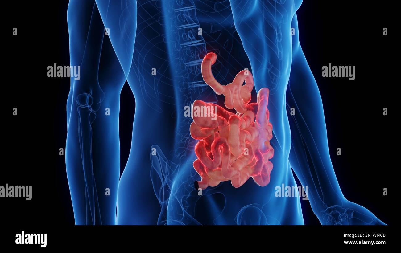 Inflamed small intestine, illustration Stock Photo - Alamy