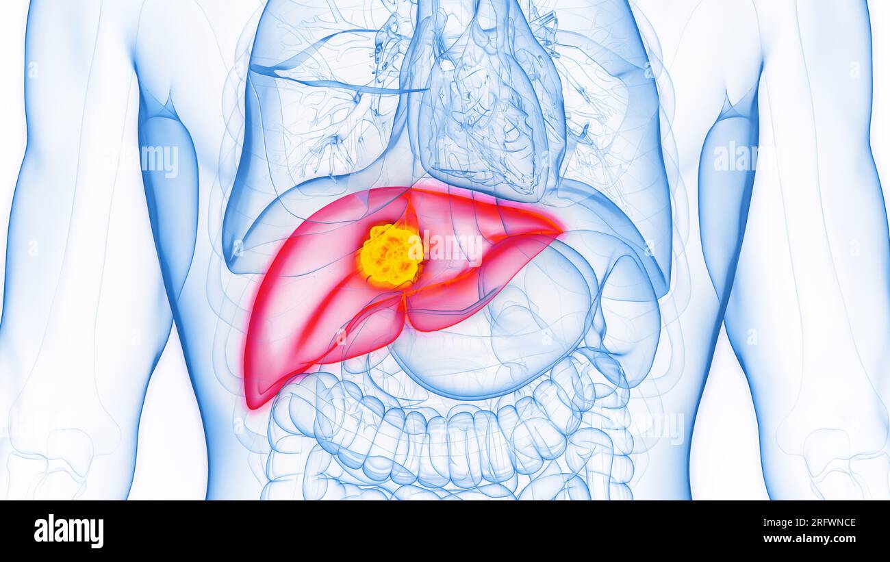 Liver cancer, illustration Stock Photo - Alamy