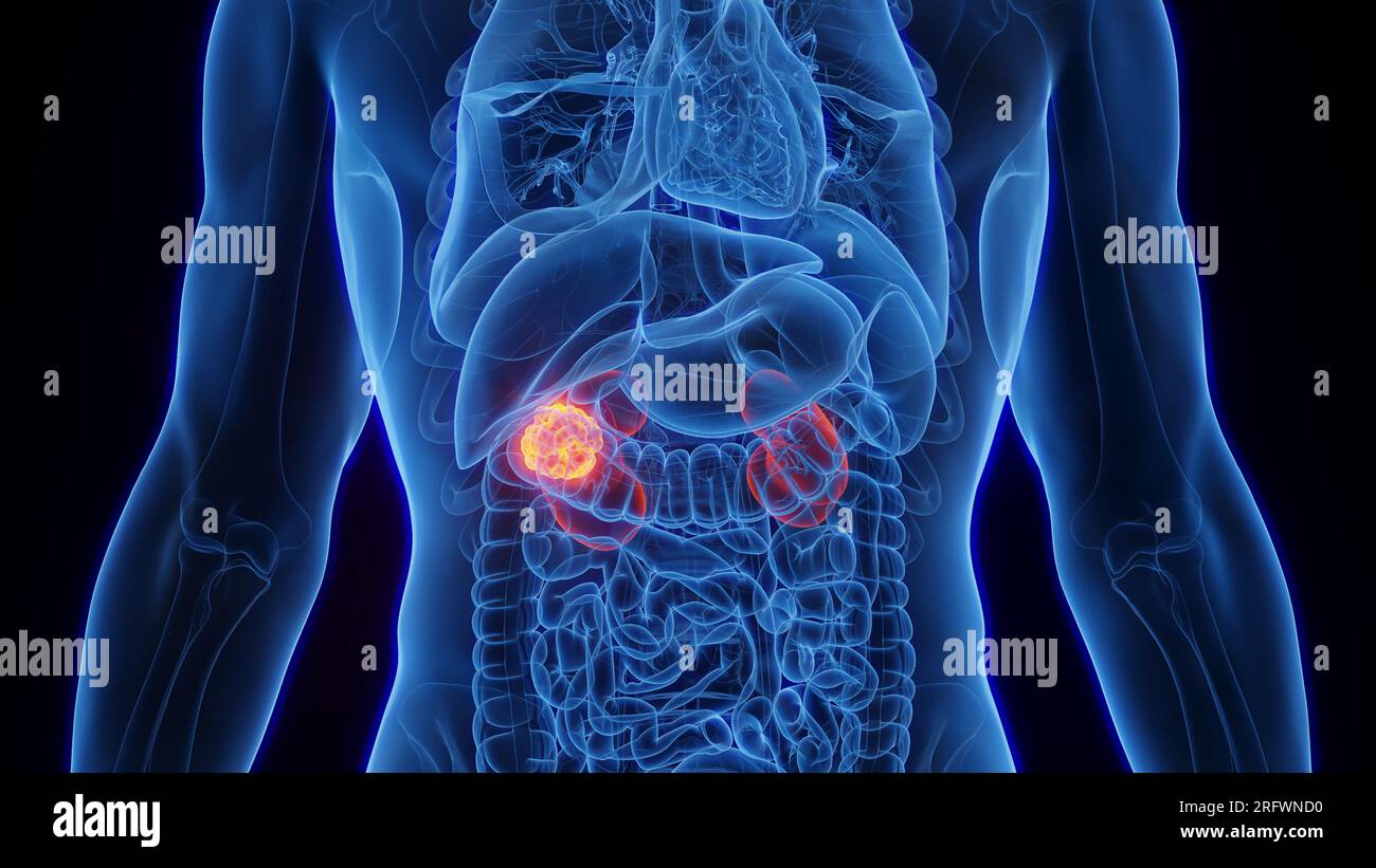 Kidney cancer, illustration Stock Photo - Alamy