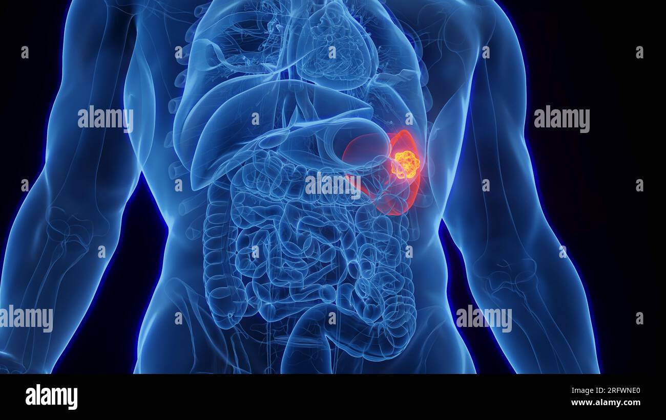 Splenic cancer, illustration Stock Photo - Alamy