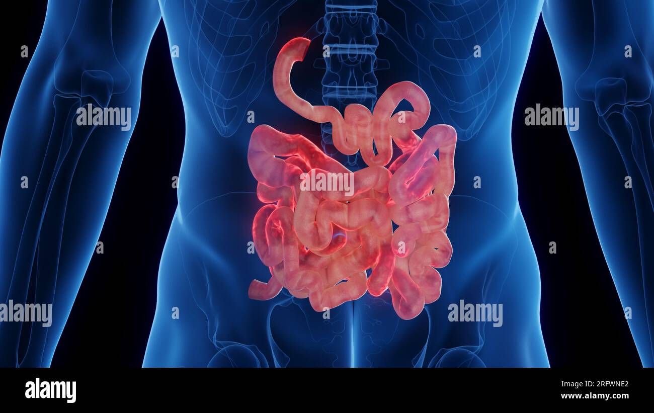 Inflamed small intestine, illustration Stock Photo - Alamy