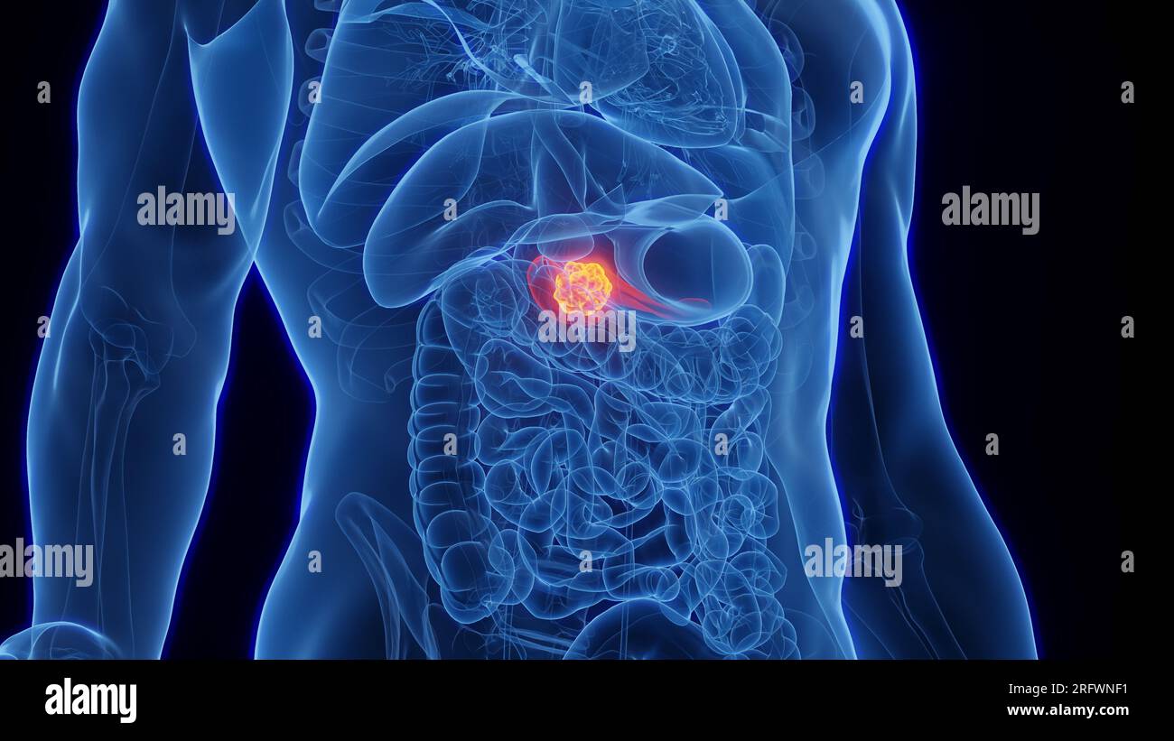 Pancreatic cancer, illustration Stock Photo - Alamy