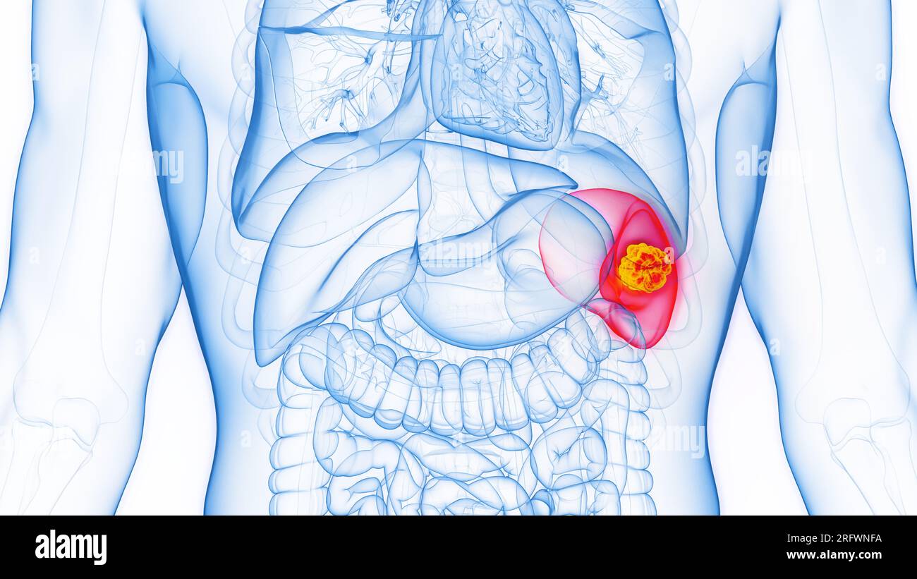 Splenic cancer, illustration Stock Photo - Alamy