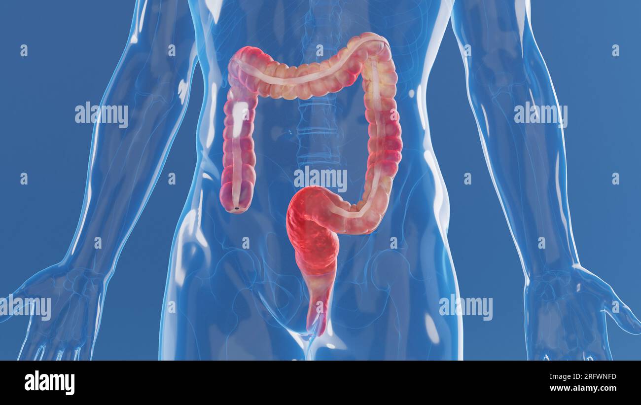 Inflamed colon, illustration Stock Photo - Alamy