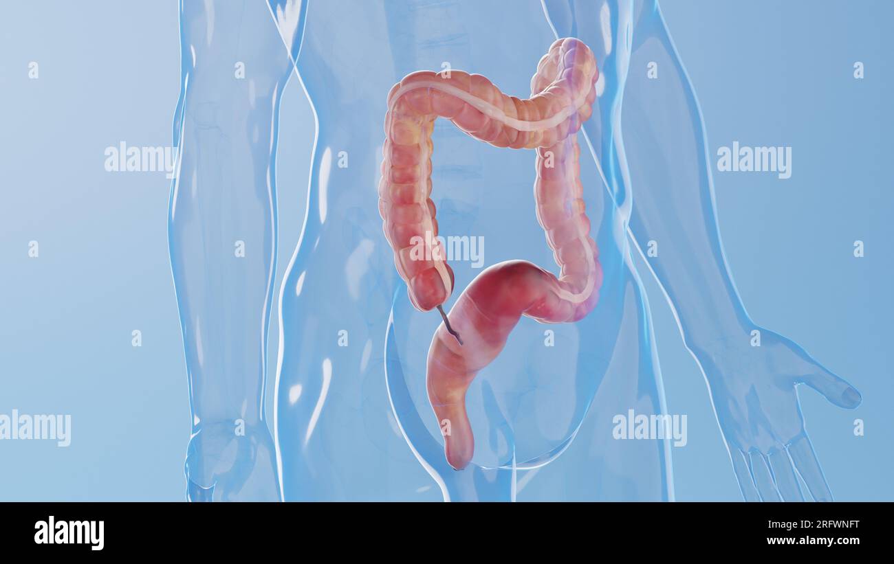 Inflamed colon, illustration Stock Photo - Alamy