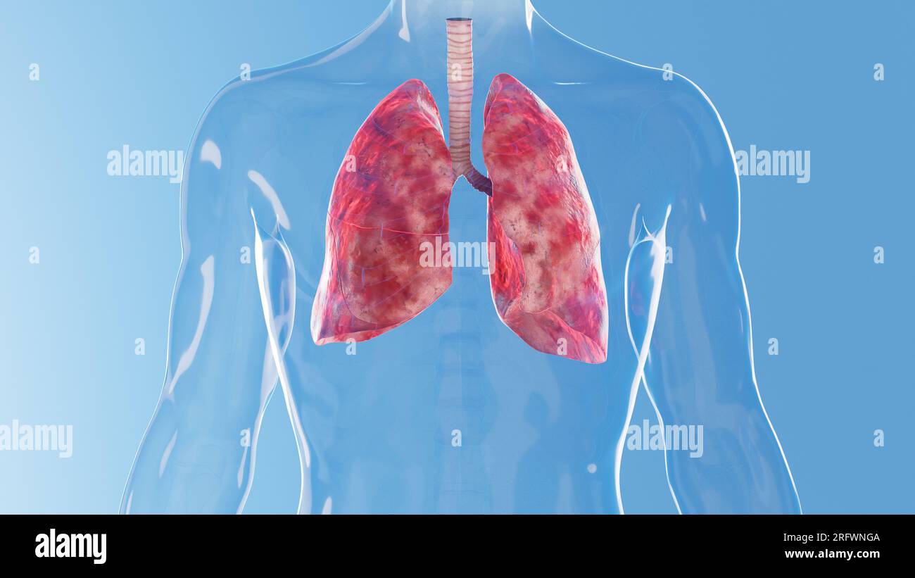 Inflamed lungs, illustration Stock Photo - Alamy