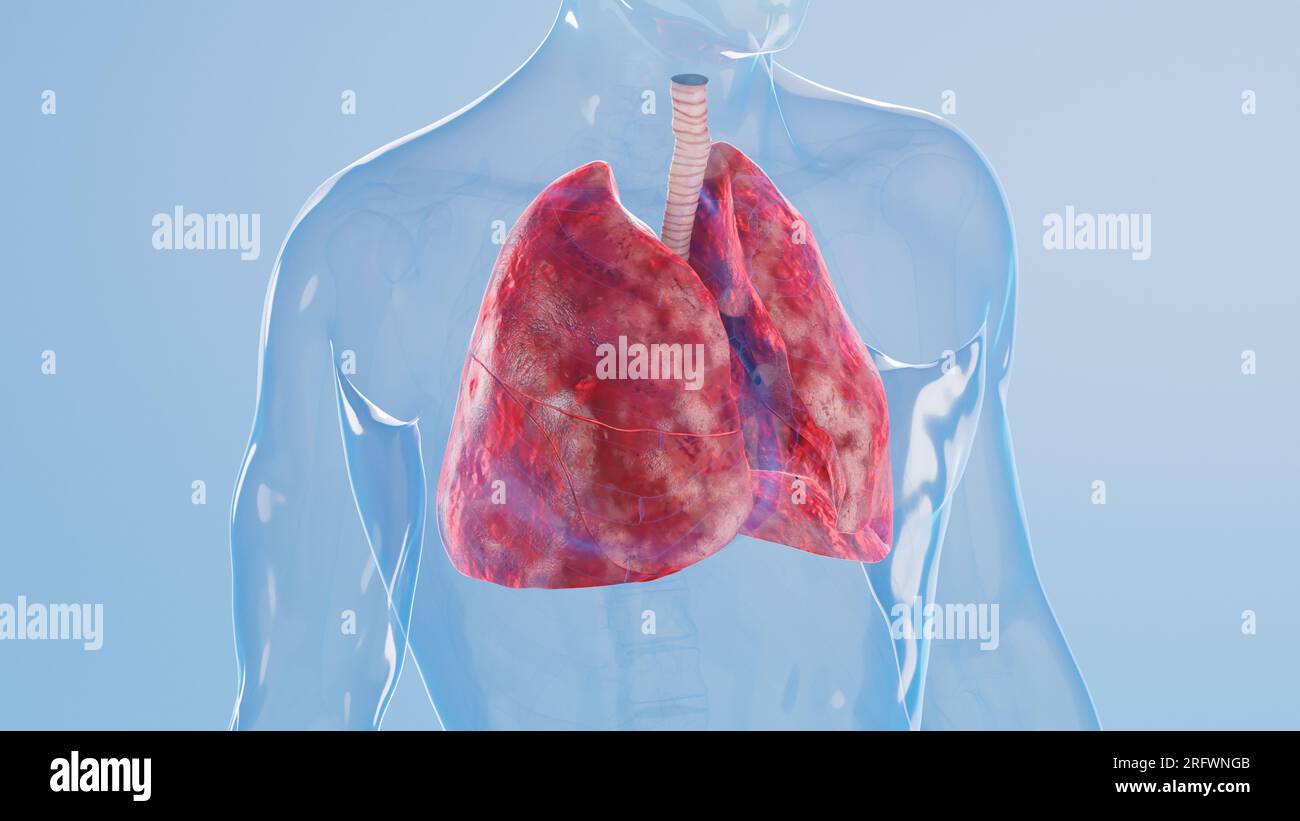 Inflamed lungs, illustration Stock Photo - Alamy